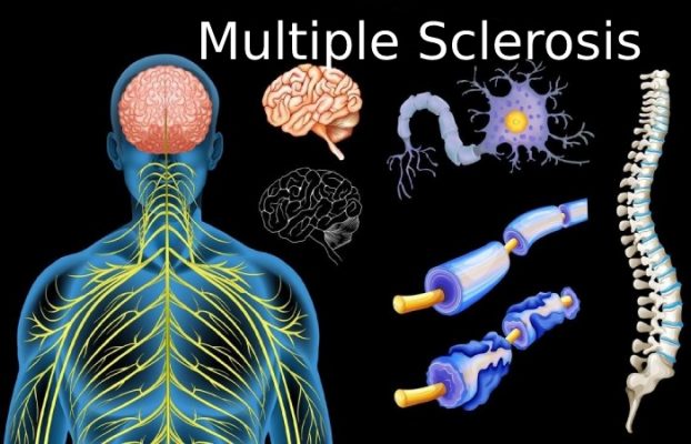 What is Multiple Sclerosis? - Types, Disease, Symptoms, and More